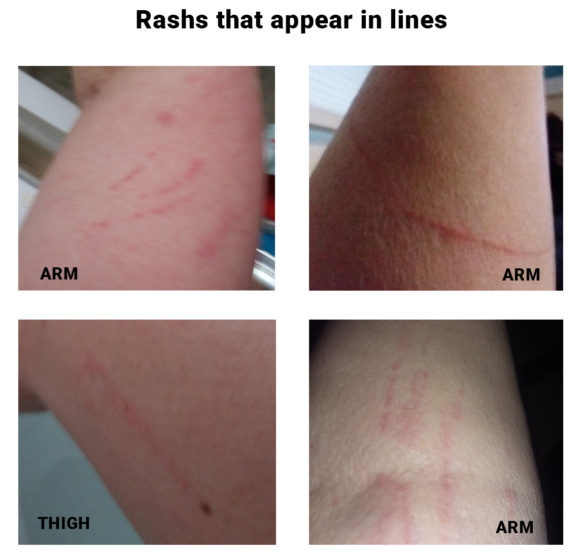 Do these hives look familiar to you? : r/MCAS